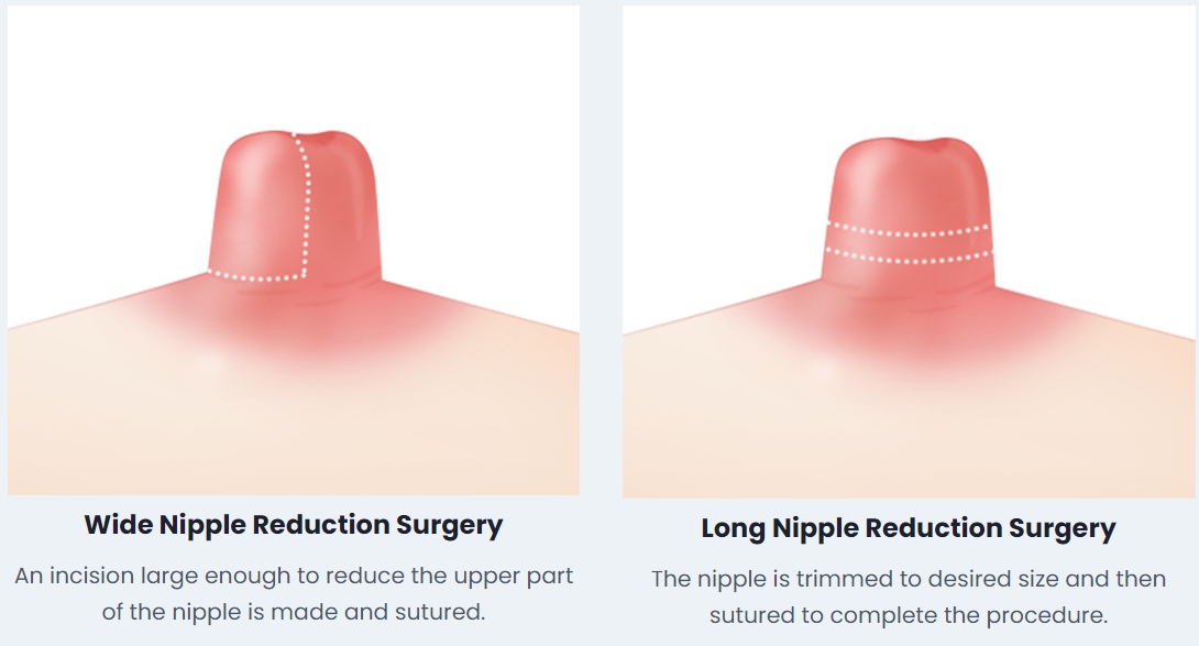 Nipple Surgery In Korea The Costs Best Clinics Procedure Details